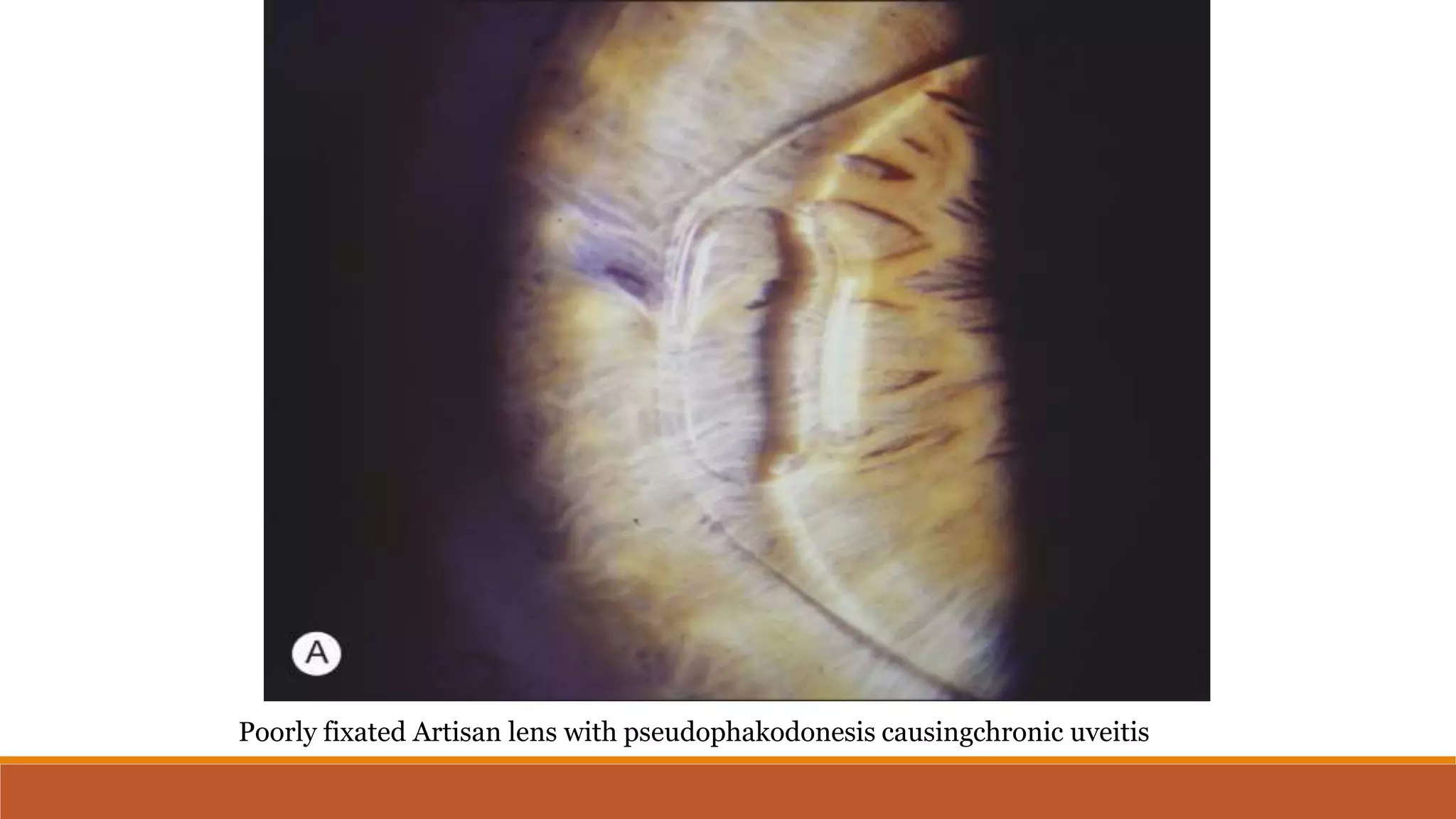 Phakic iol ppt | PPTX