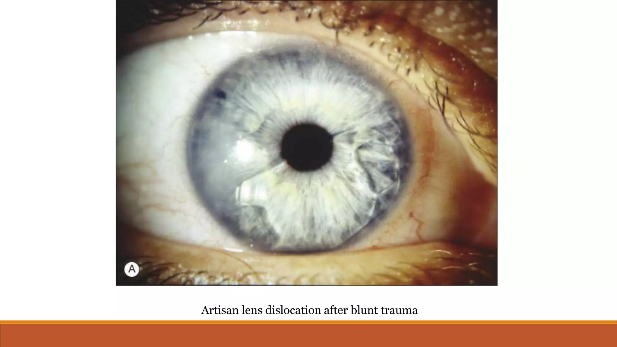 Phakic iol ppt | PPTX