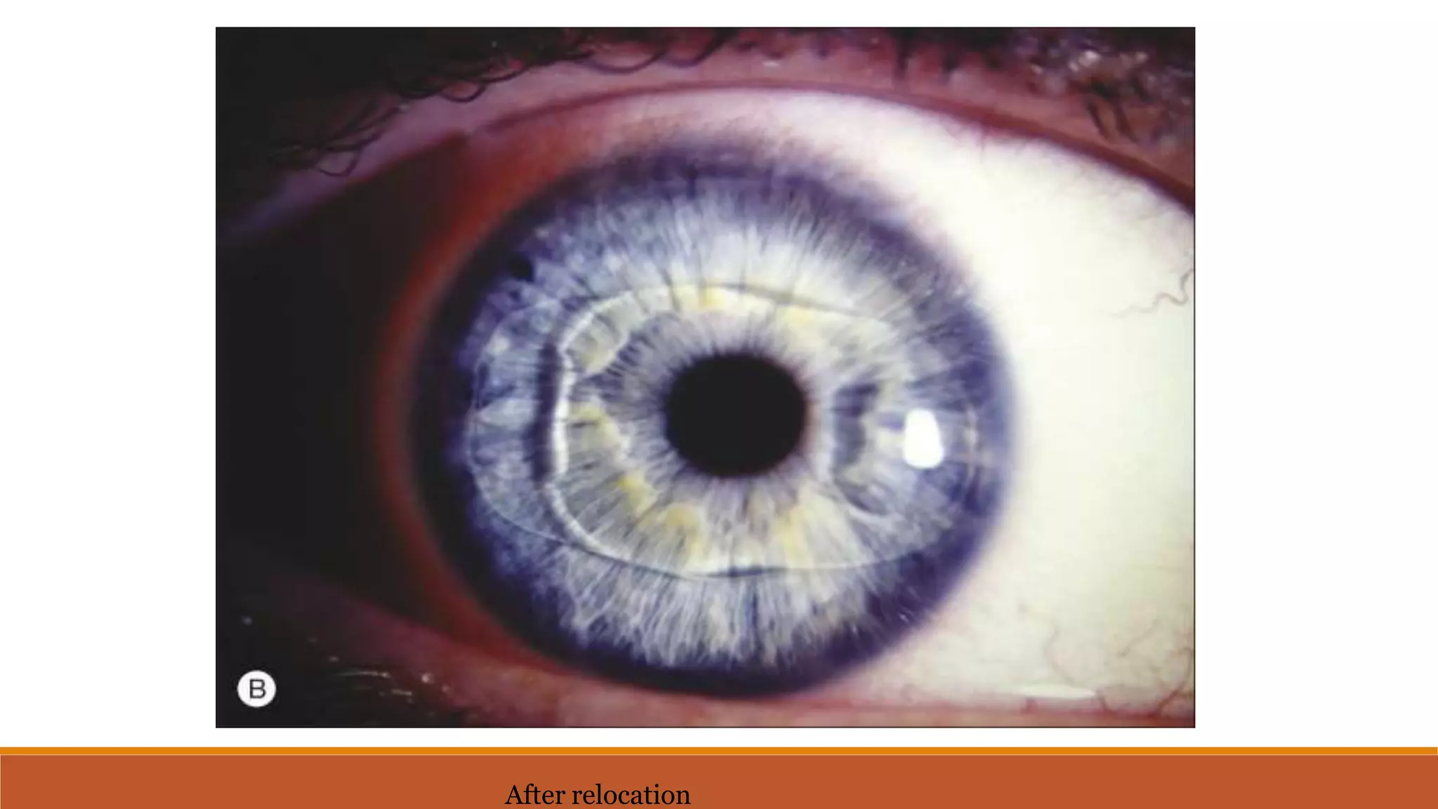 Phakic iol ppt | PPTX