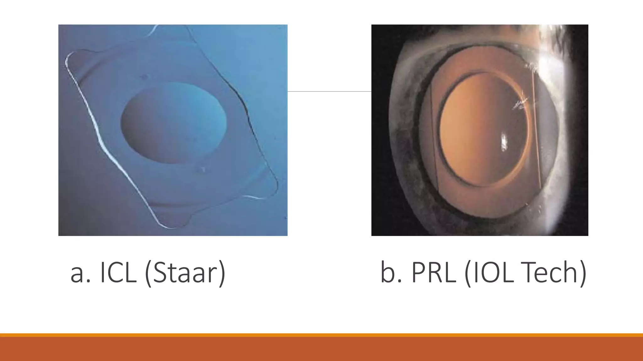 Phakic iol ppt | PPTX