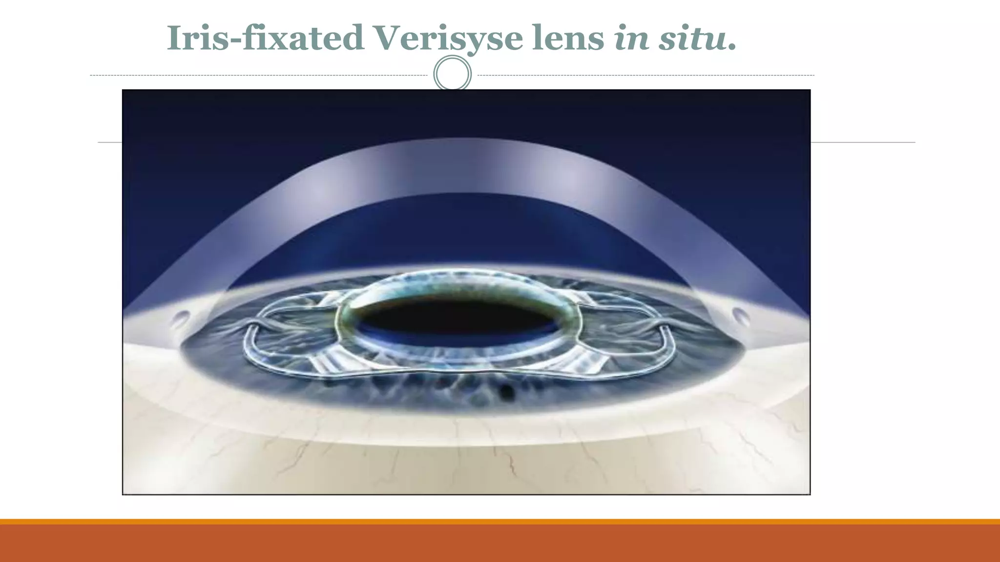 Phakic iol ppt | PPTX