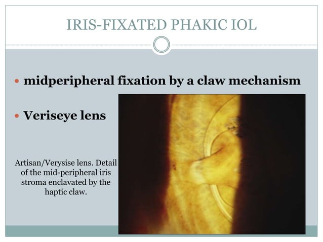 Phakic IOL | PPTX | Eye and Vision Conditions | Diseases and Conditions