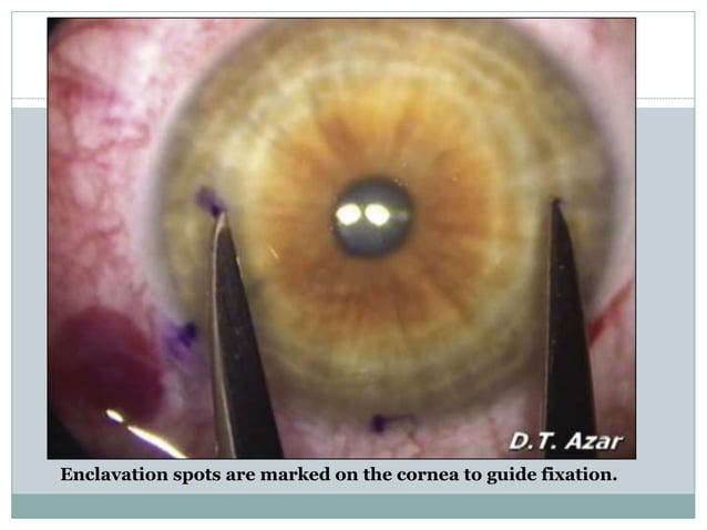 Phakic IOL | PPTX | Eye and Vision Conditions | Diseases and Conditions