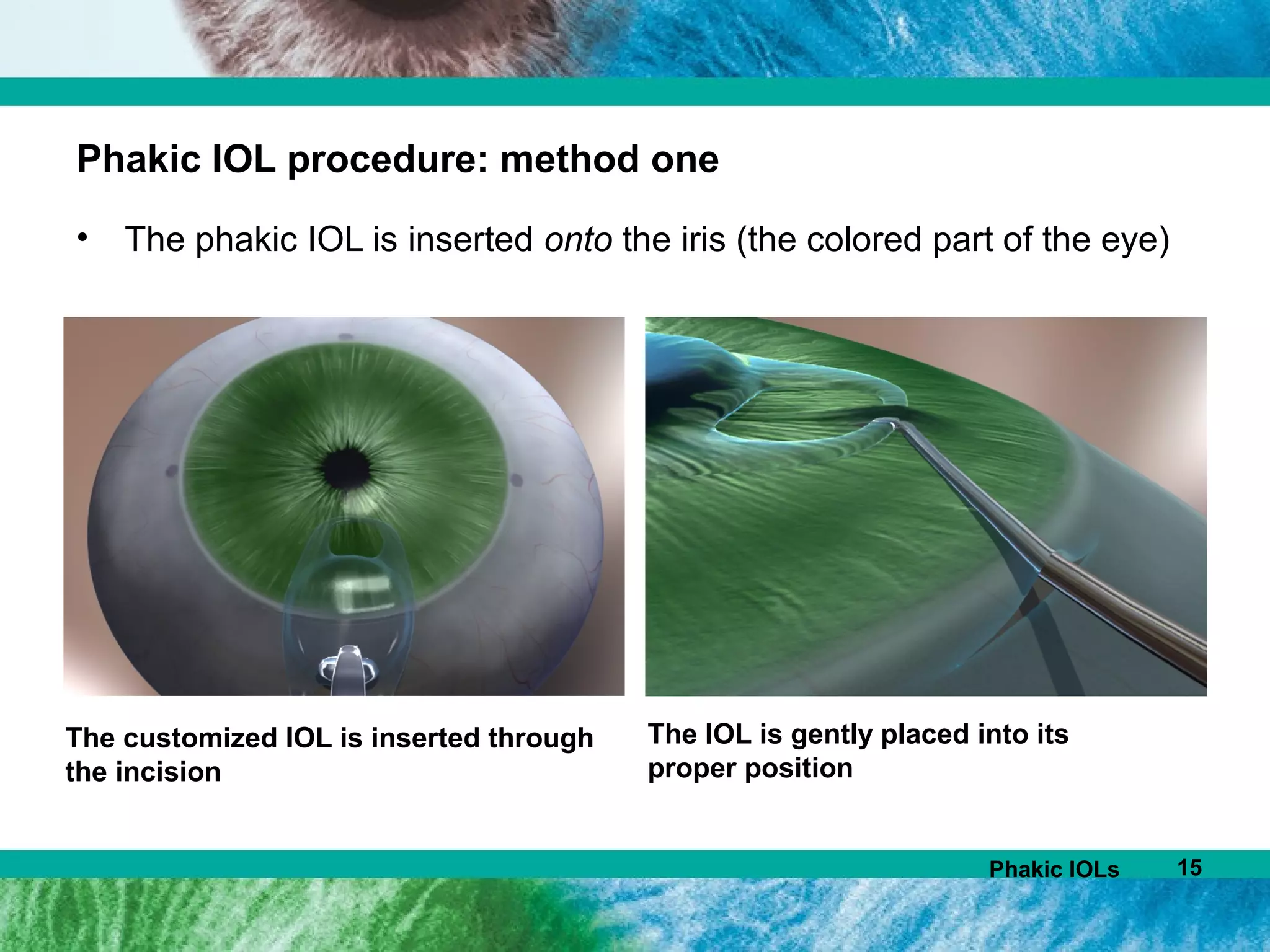 Phakic Intraocular implants in 2017 | ODP