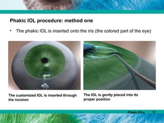 Phakic Intraocular implants in 2017 | ODP