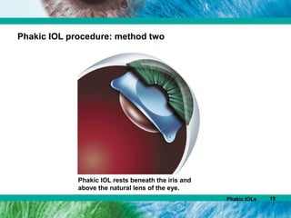 Phakic Intraocular implants in 2017 | PPT