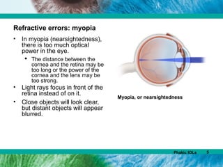Phakic Intraocular implants in 2017 | ODP