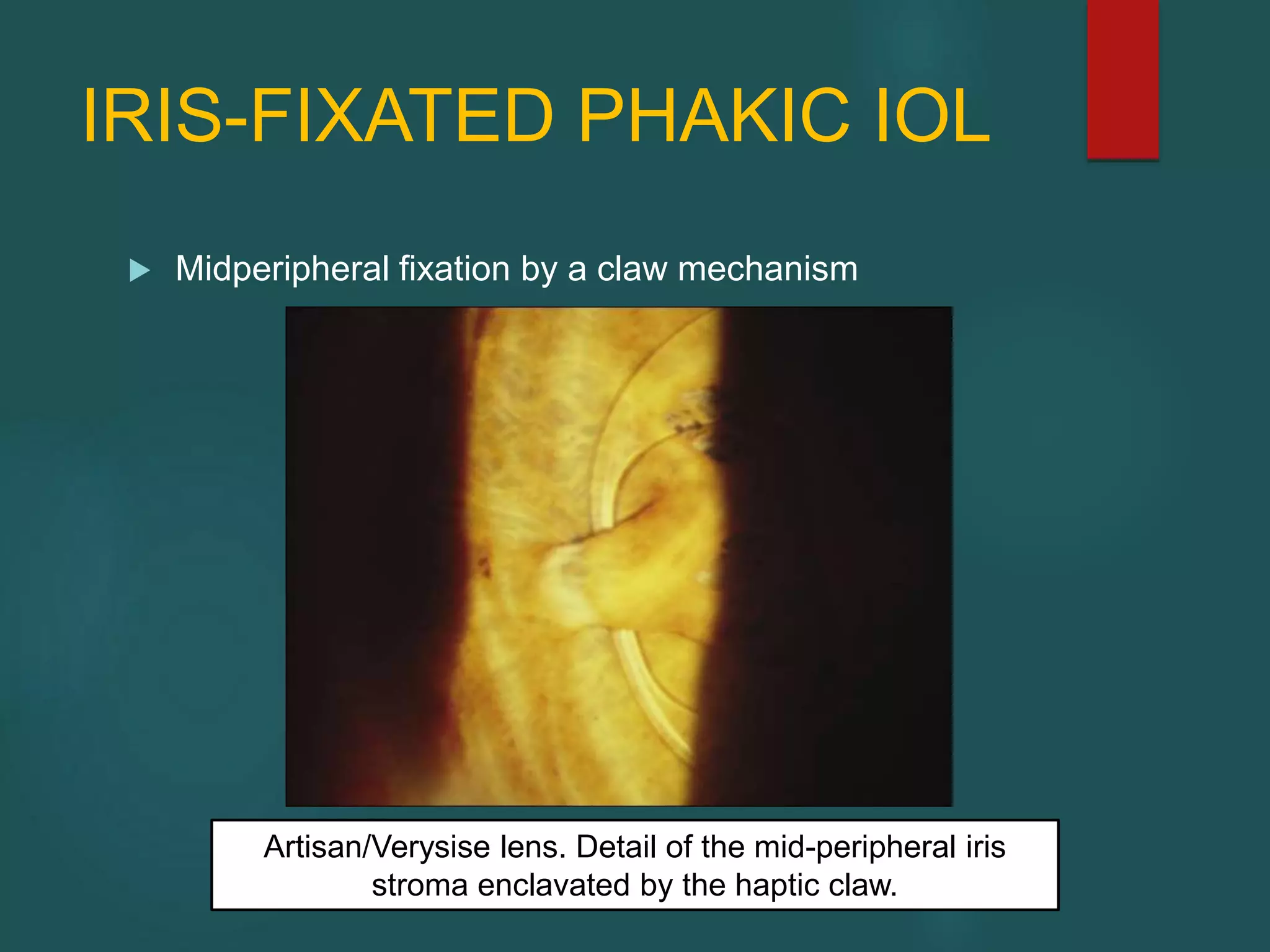 Phakic Intraocular lens | PPTX