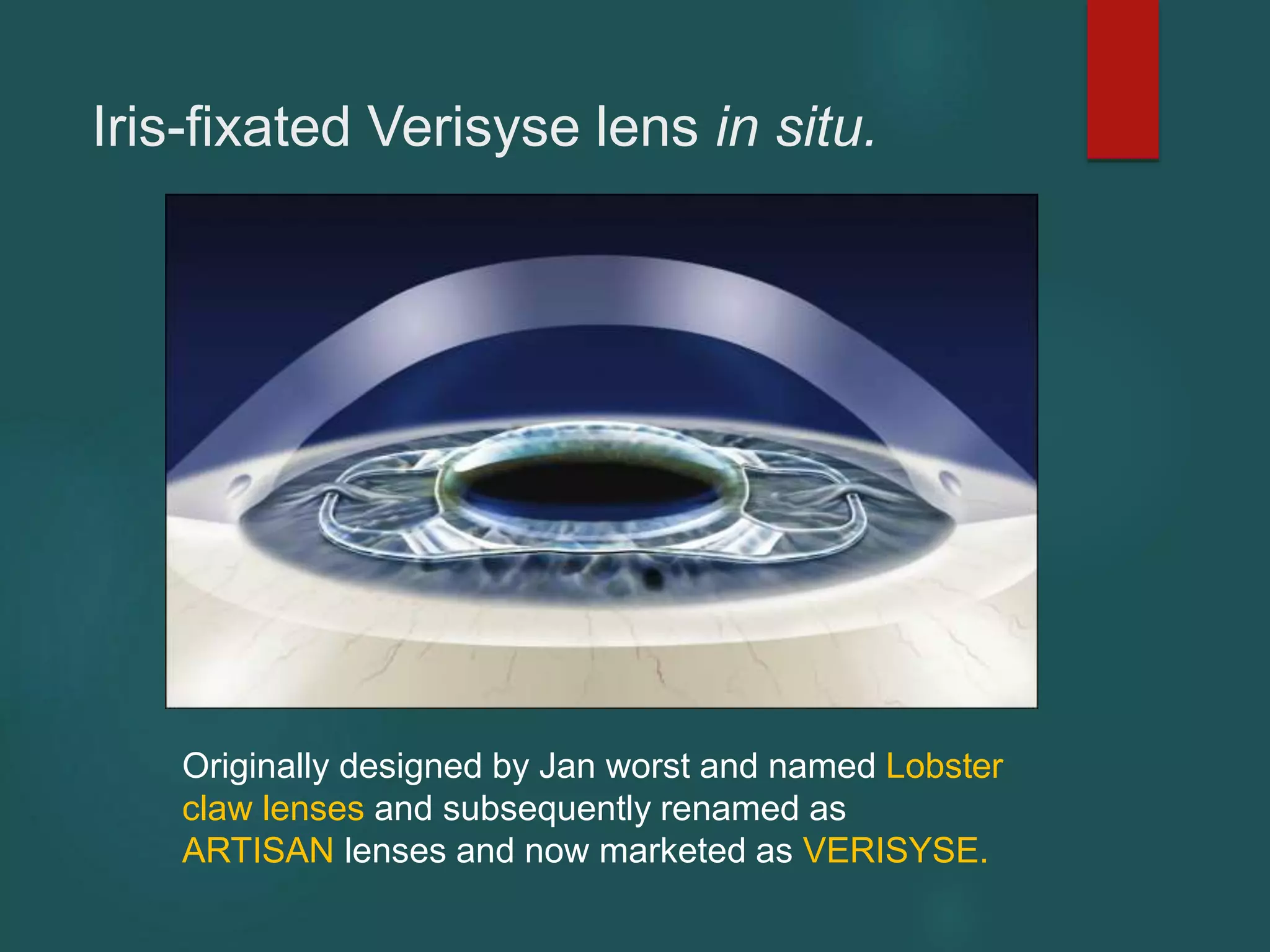 Phakic Intraocular lens | PPTX | Eye and Vision Conditions | Diseases and Conditions