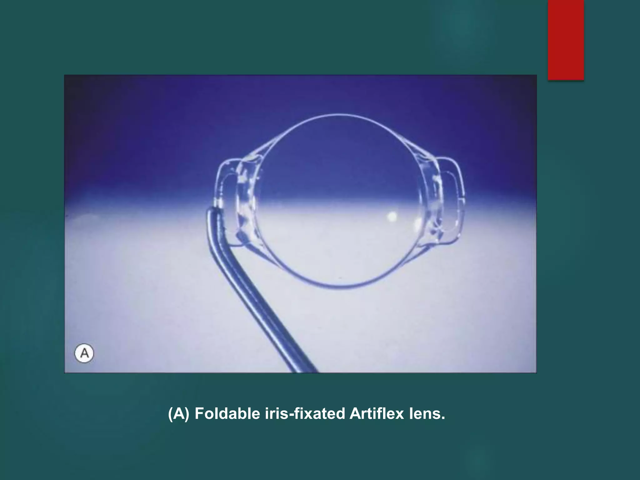 Phakic Intraocular lens | PPTX | Eye and Vision Conditions | Diseases and Conditions