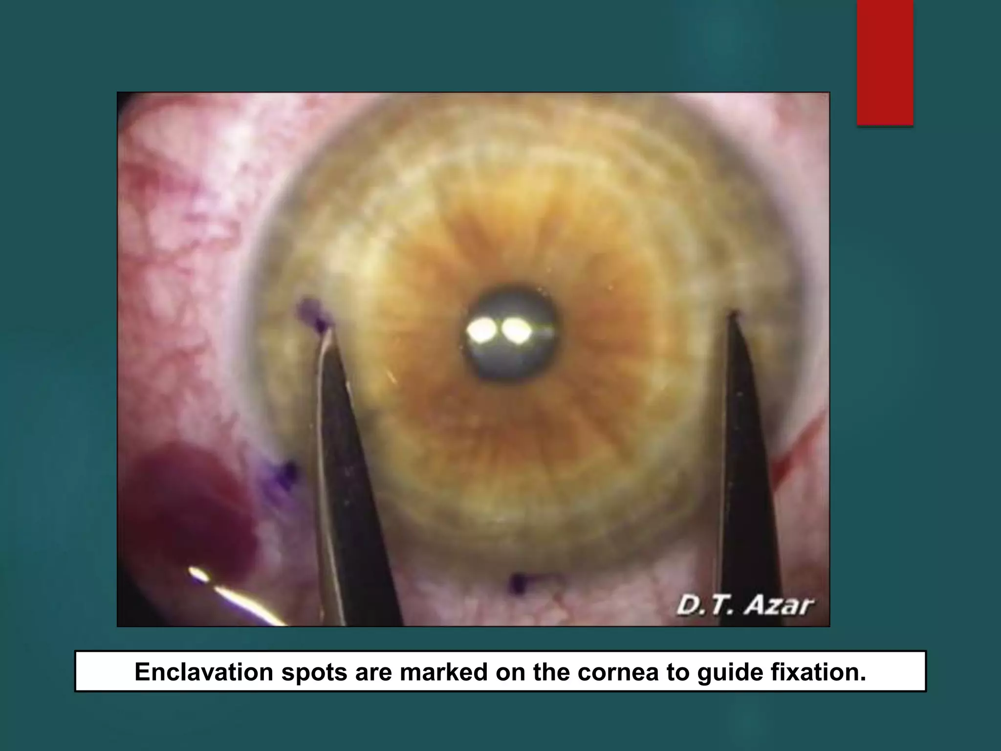 Phakic Intraocular lens | PPTX | Eye and Vision Conditions | Diseases ...