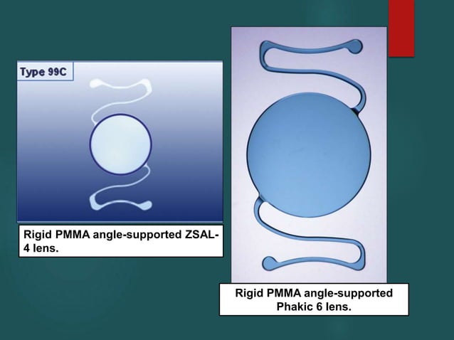 Phakic Intraocular lens | PPTX | Eye and Vision Conditions | Diseases ...