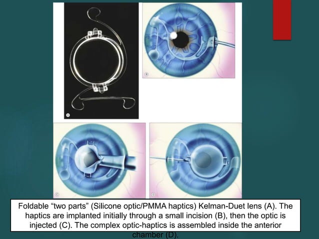 Phakic Intraocular lens | PPTX | Eye and Vision Conditions | Diseases and Conditions