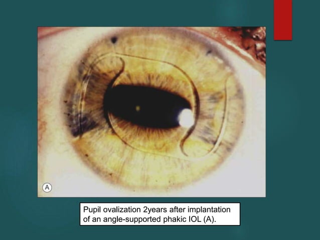 Phakic Intraocular lens | PPTX | Eye and Vision Conditions | Diseases and Conditions
