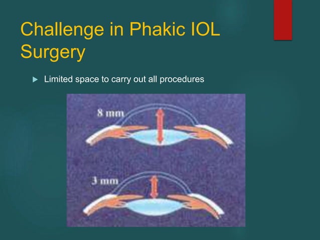 Phakic Intraocular lens | PPTX | Eye and Vision Conditions | Diseases ...