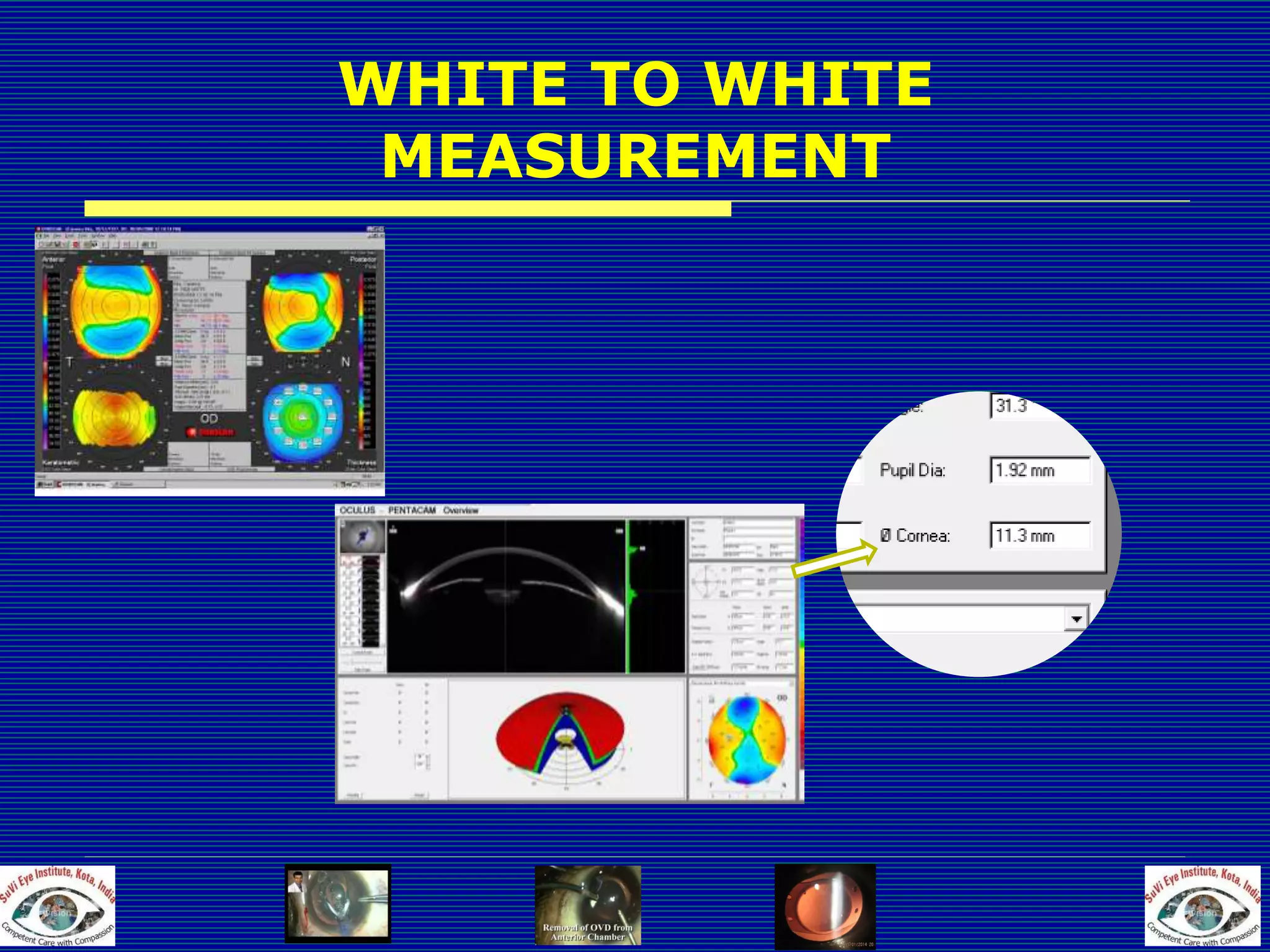 Phakic lens implantation, technique, complications & management by dr ...