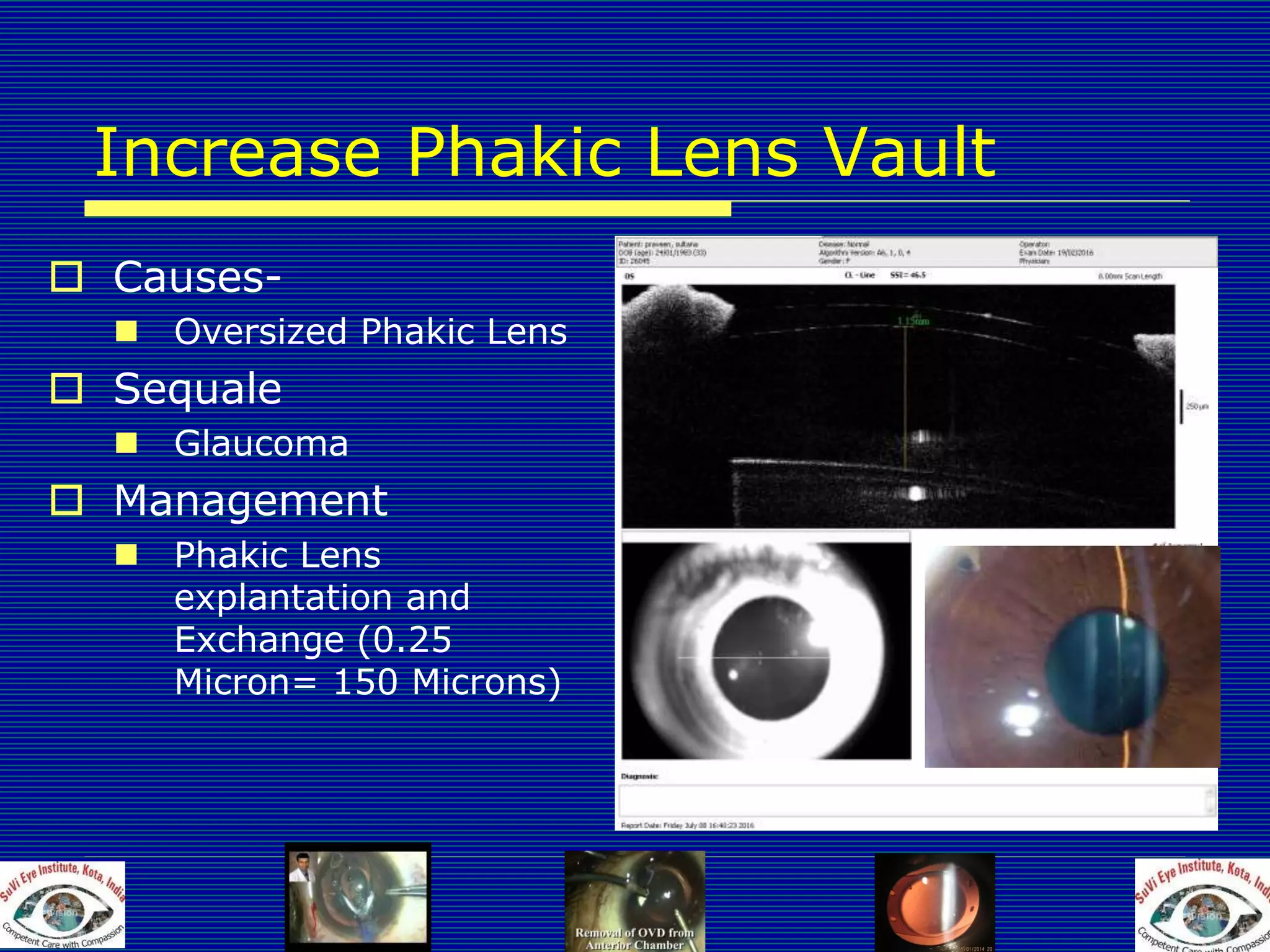 Phakic lens implantation, technique, complications & management by dr ...
