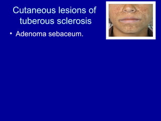 Tuberous Sclerosis Adenoma Sebaceum