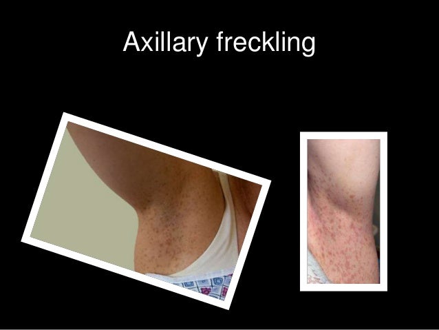 Imaging in Phakomatoses