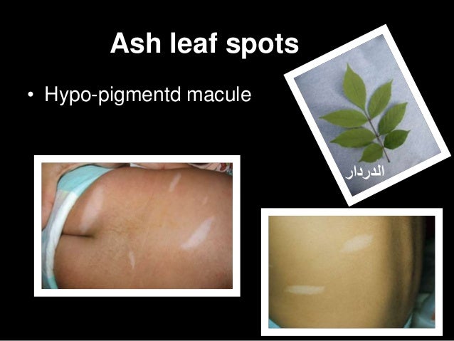 Imaging in Phakomatoses