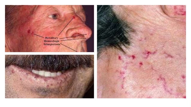 Phakomatoses + Congenital Metabolic disorders.pptx