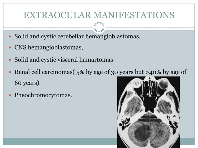 Phakomatoses ppt | PPTX | Eye and Vision Conditions | Diseases and ...