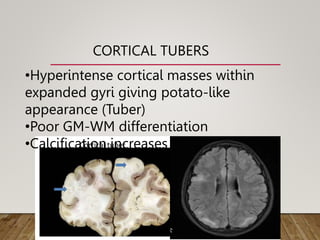 PHAKOMATOSIS or Neurocutanepus syndromes radiology.pptx