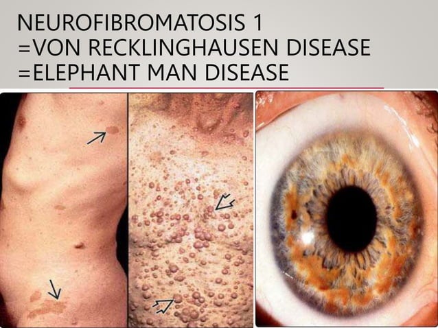 PHAKOMATOSIS or Neurocutanepus syndromes radiology.pptx