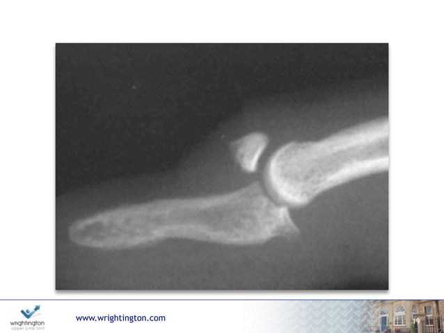 Hand Fractures and Dislocations | PDF