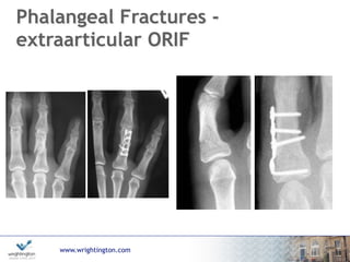 Hand Fractures and Dislocations | PDF