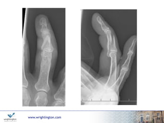 Hand Fractures and Dislocations | PDF