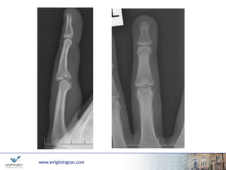 Hand Fractures and Dislocations | PDF