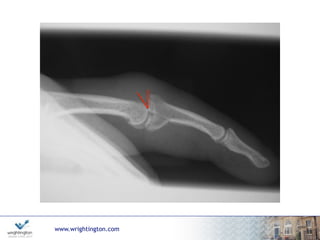 Hand Fractures and Dislocations | PDF