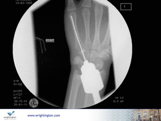 Hand Fractures and Dislocations | PDF