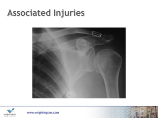 Hand Fractures and Dislocations | PDF