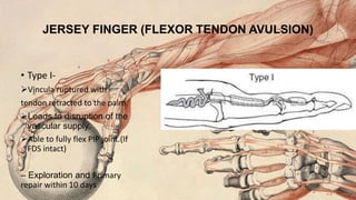 Phalangeal fractures of hand | PPTX