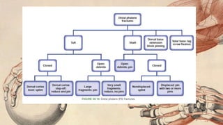 Phalangeal fractures of hand | PPTX
