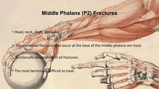 Phalangeal fractures of hand | PPTX