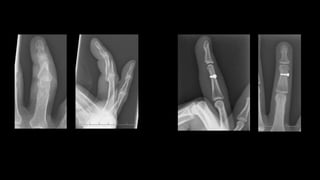Phalangeal fractures of hand | PPTX