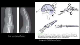 Phalangeal fractures of hand | PPTX
