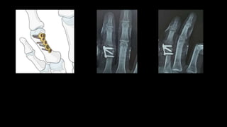 Phalangeal fractures of hand | PPTX