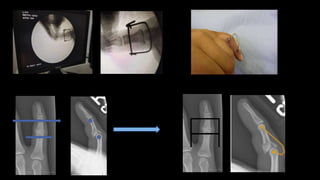 Phalangeal fractures of hand | PPTX