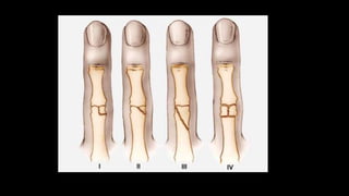 Phalangeal fractures of hand | PPTX