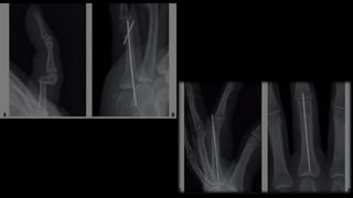 Phalangeal fractures of hand | PPTX
