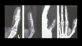 Phalangeal fractures of hand | PPTX
