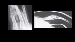 Phalangeal fractures of hand | PPTX