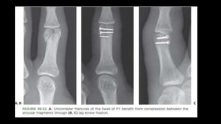 Phalangeal fractures of hand | PPTX