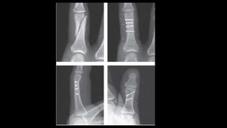 Phalangeal fractures of hand | PPTX