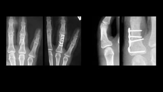 Phalangeal fractures of hand | PPTX