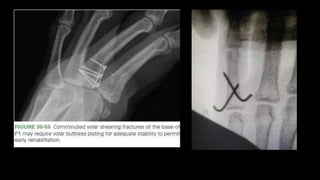Phalangeal fractures of hand | PPTX